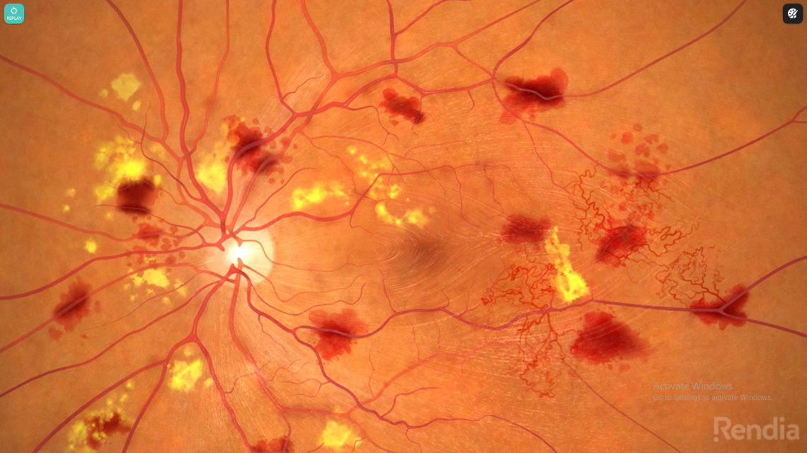 Diabetic Retinopathy – Laser Eye Centre Ltd